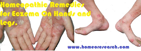 Homeopathic Remedies for Severe Eczema on hands and legs ...