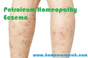 Indications of Petroleum homeopathy eczema – Homeoresearch.com