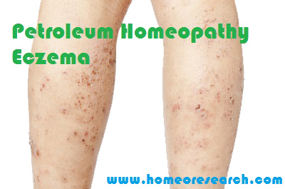 Indications of Petroleum homeopathy eczema – Homeoresearch.com